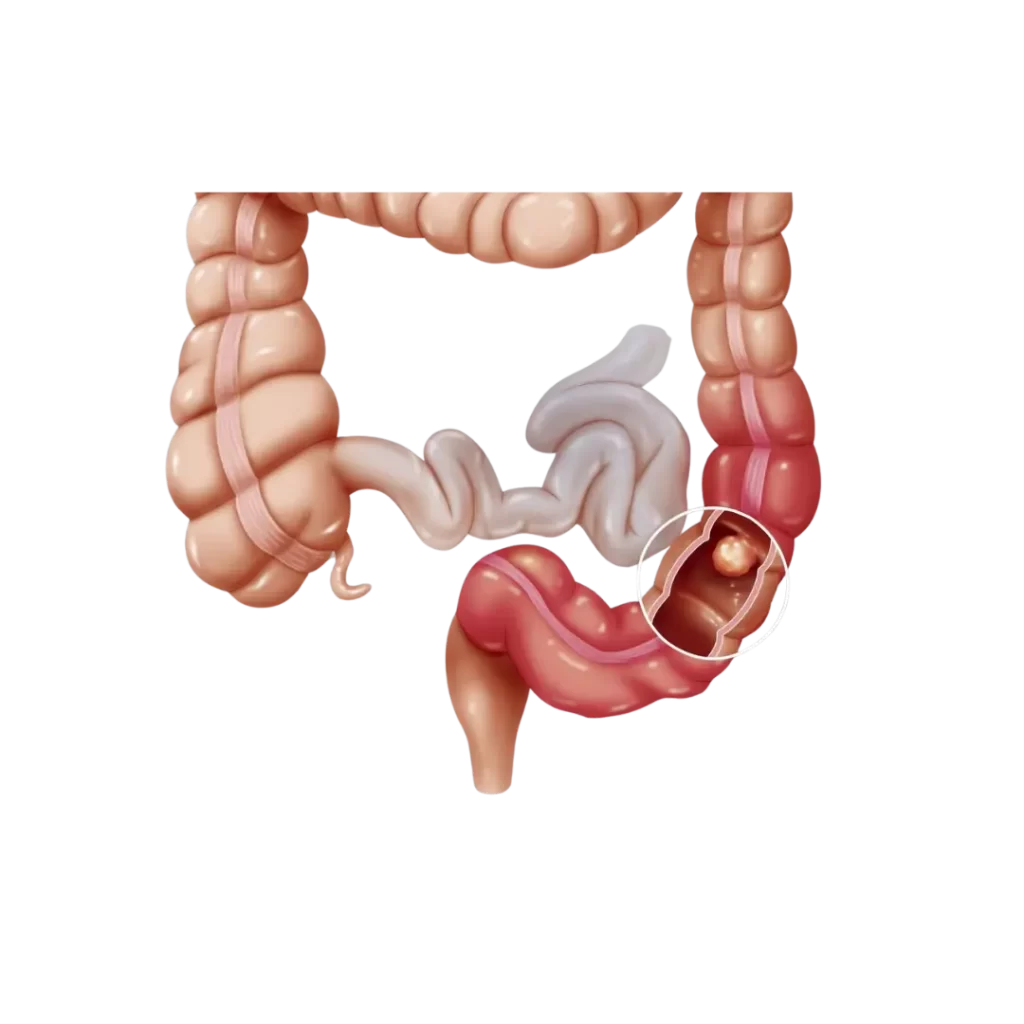 Bowel Obstruction Intestinal Obstruction Dr Kumargurubaran Bowel Obstruction Intestinal Obstruction Dr Kumargurubaran
